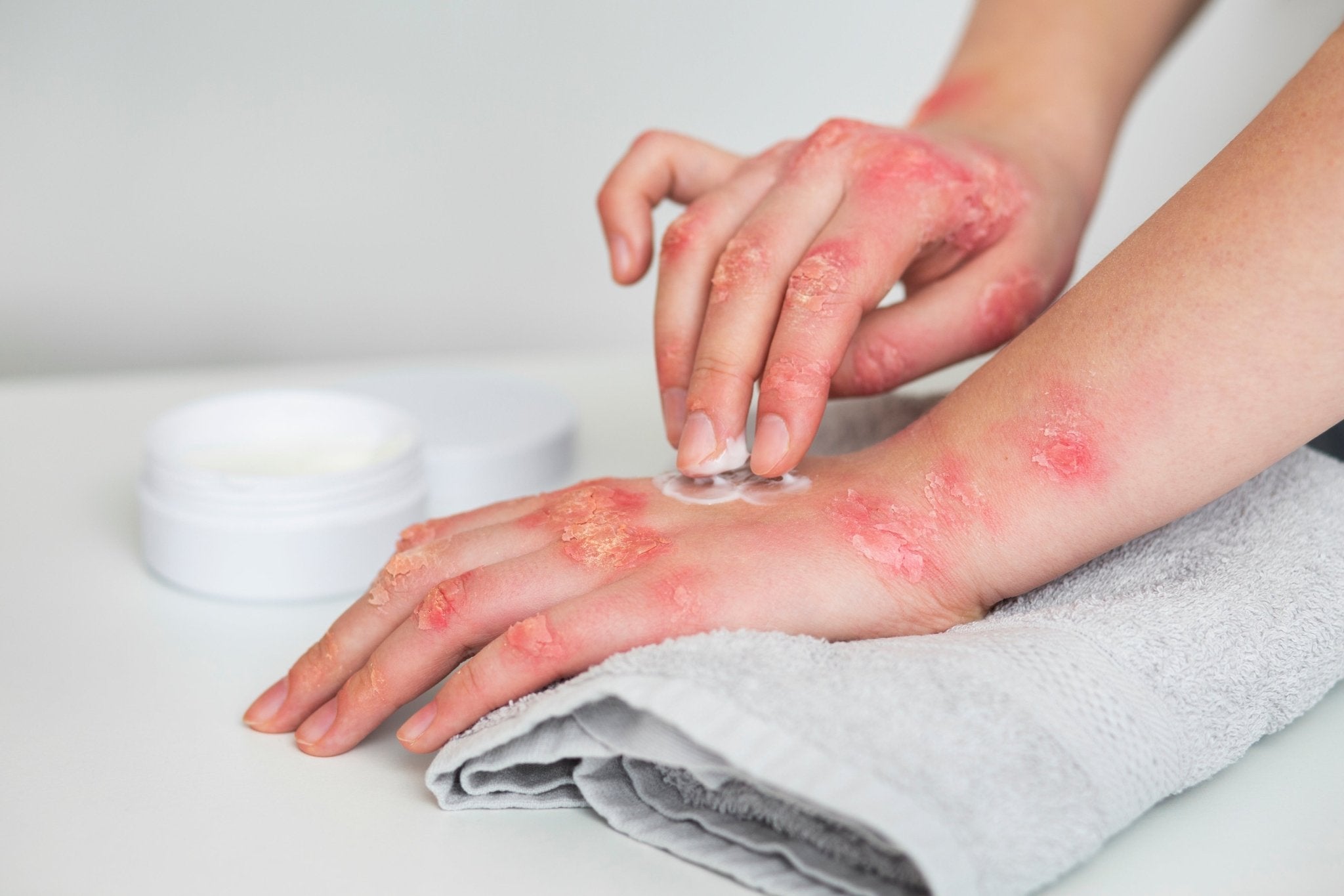 When to Stop Using Topical Steroids: 4 Key Signs – Scrachee